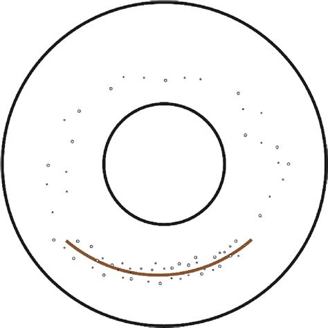 Schematic Representation Of The Distribution Of Epithelial Microcysts