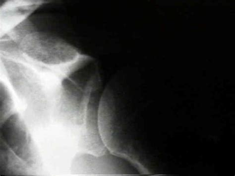 Floating Shoulder Injuries Wheeless Textbook Of Orthopaedics