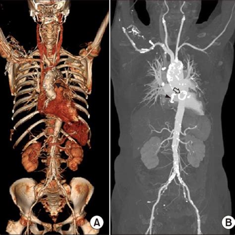 A B Preoperative Computed Tomography Demonstrating Diffuse And Heavy Download Scientific