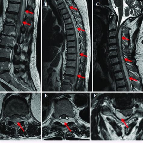 Patients With Upper Cervical Pyogenic Epidural Abscess Download Scientific Diagram