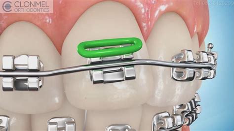 Braces Color Chooser