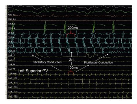 Focal Automatic Firing Cycle Length 100 Ms From Lspv Enters The La Download Scientific