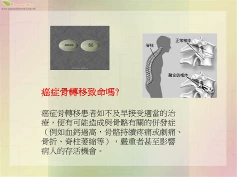 Ppt 癌症骨轉移 Powerpoint Presentation Free Download Id4908835