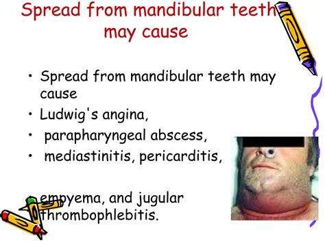 Dental Caries Ppt Ppt