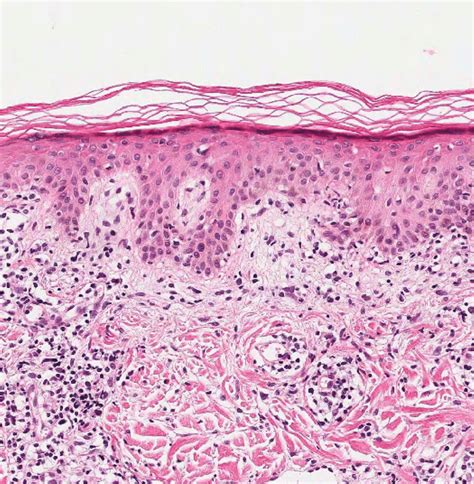 A Lymphohistiocytic Infiltration Along Dermoepidermal Junction And