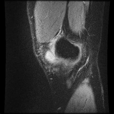 Anterior Cruciate Ligament Tear Radiopaedia 61500 69462 F Nc Commons