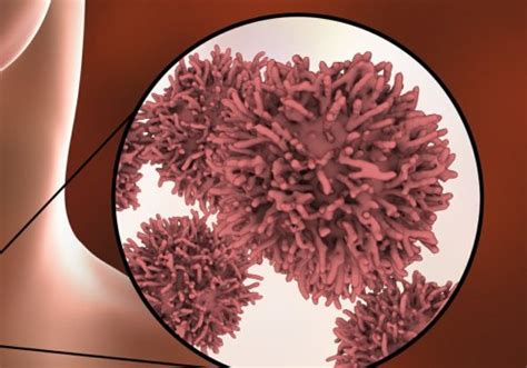 When Does Thyroid Cancer Spread