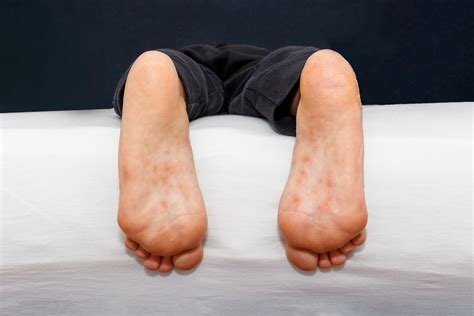 Eczema In Adults Diagnosis Photos And Treatments