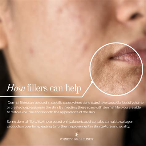 Understanding Acne Types Causes And Effective Treatments — Cosmetic
