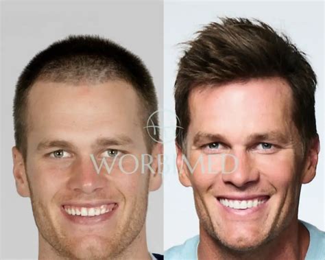 Tom Brady Hair Transplant L Before And After