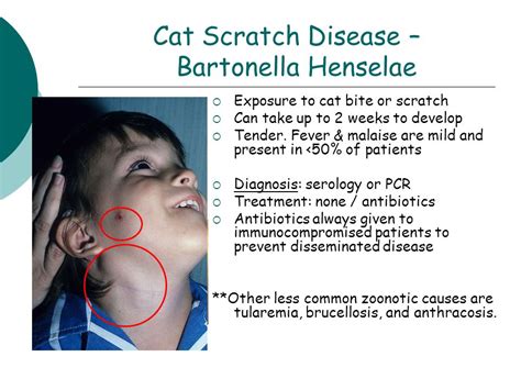 Antibiotics For Cat Scratch Cellulitis