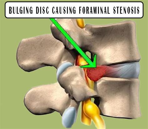 The Ultimate Non Surgical Solution For Foraminal Stenosis In Cary Nc