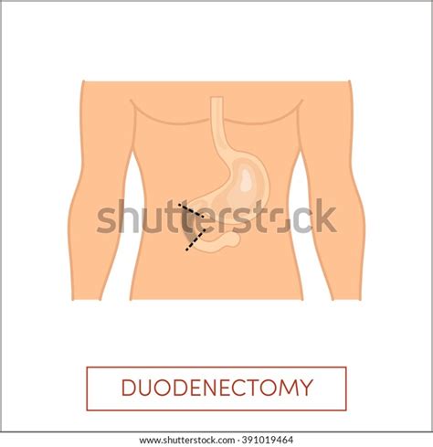 Duodenectomy Partial Excision Duodenum Vector Illustration Stock Vector Royalty Free 391019464