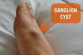 Ganglion Cyst Ankle