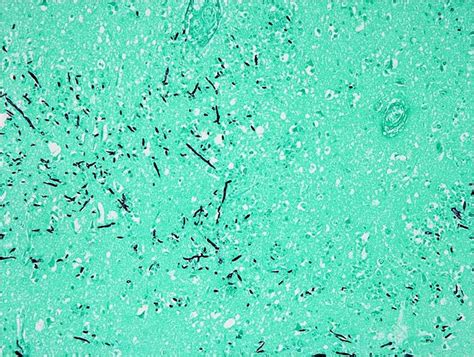 Dissemination Of Invasive Aspergillosis Diagnostic And Management