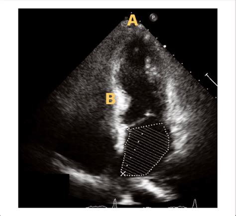 Echocardiogram Reveals Apical Akinesis A And Basal Hyperkinesis B