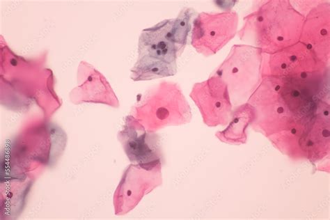 Iew In Microscopic Of Abnormal Human Cervix Cellssquamous Epithelium