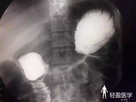 16歲女性，出現腹脹不適，診斷：胃扭轉？ 每日頭條