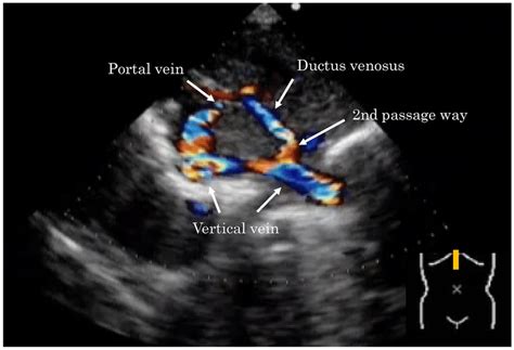 Echocardiogram In Case 1 Before Ductus Venosus Stent Placement