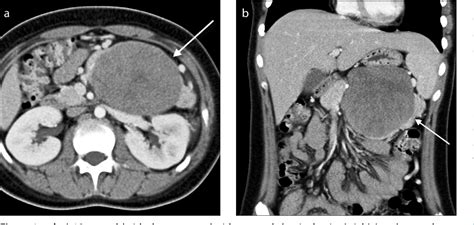 Table 1 From Solid Pseudopapillary Neoplasm Of The Pancreas Ct Imaging Features And Radiologic