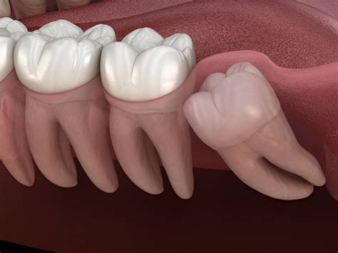 Apa Itu Wisdom Teeth Dan Bagaimana Cara Mengatasinya Klinik Gigi Satu Dental