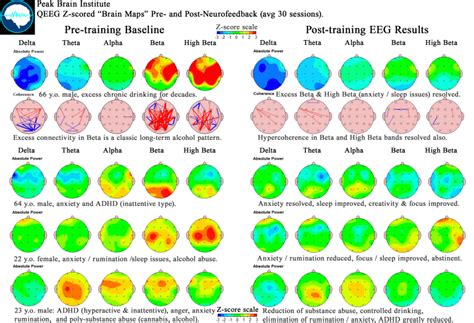 QEEG Brain Mapping Peak Brain Institute
