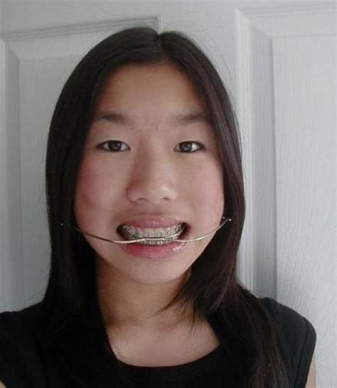 Pin By John Beeson On Girls In Headgear In 2021 Braces Girls
