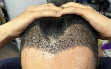 男生植发形状选择指南：6种风格大解析！