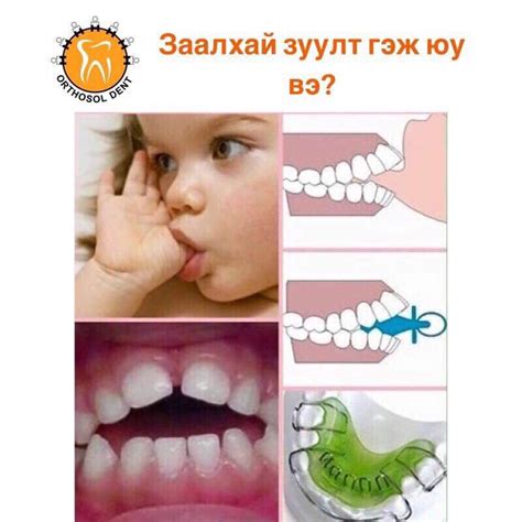 Orthosoldent Orthosoldentalclinic зөвлөж байна Заалхай зуулт гэж юу вэ Хүүхэд тань хуруугаа