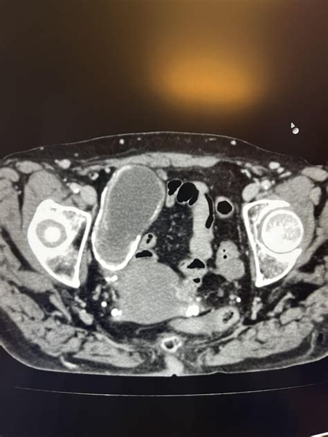 Calcified Pelvic Mass Rradiology