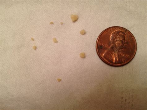 In 10 Minutes I Coughed Up 9 Tonsil Stones Rpopping
