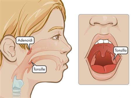Adenoidite Linfiammazione Delle Adenoidi Sintomi Cause E Trattamenti