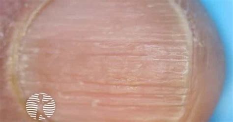 Dermnet® Nail Dystrophy Due To Lichen Planus Image