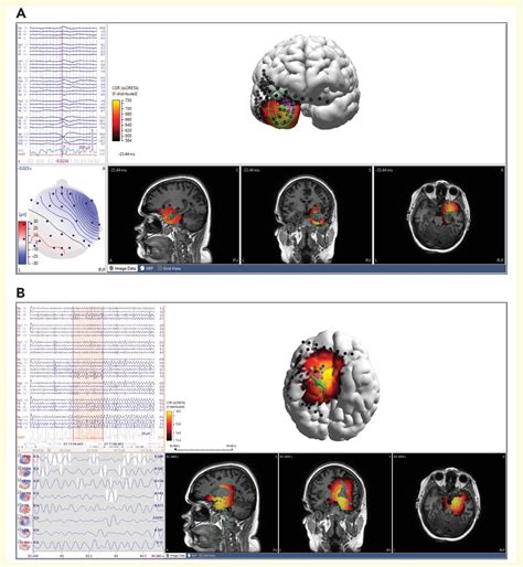 Figure From EEG Source Imaging Concordance With Intracranial EEG And Epileptologist Review In