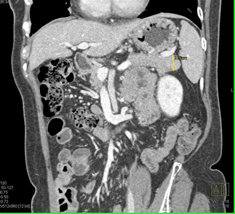 Splenule Tail Of The Pancreas Spleen Radiology Case Studies Ctisus