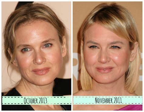 Renee Zellweger Plastic Surgery Mixture Of Skill And Technology