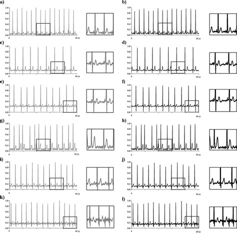 Real World Ecg Signal And Synthetic Ecg Signal On Lead 2 The Gray Line