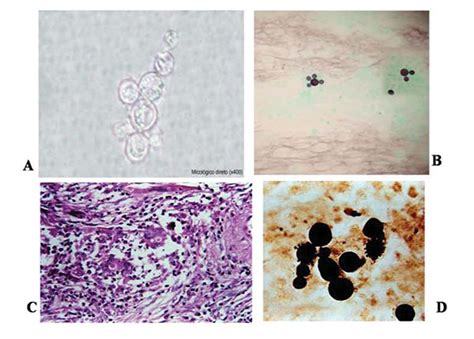 Paracoccidioidomycosis Current Perspectives From Brazil