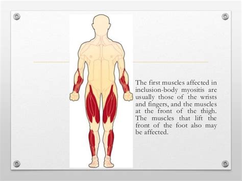 Myositis