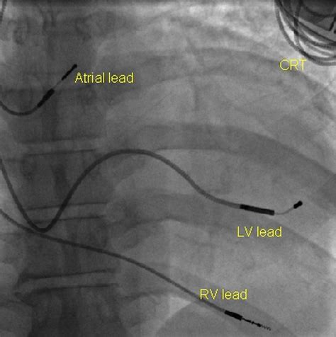 Cardiac Implantable Electronic Devices Cied On Cxr All About