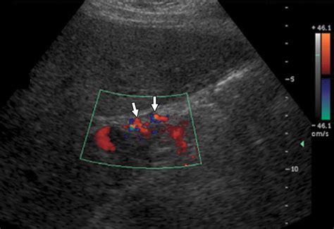 Collateral Transformation Of The Hepatic Artery After Liver Transplantation Ajr