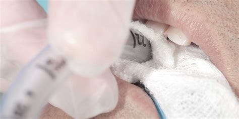 Airway Management In The ICU RT