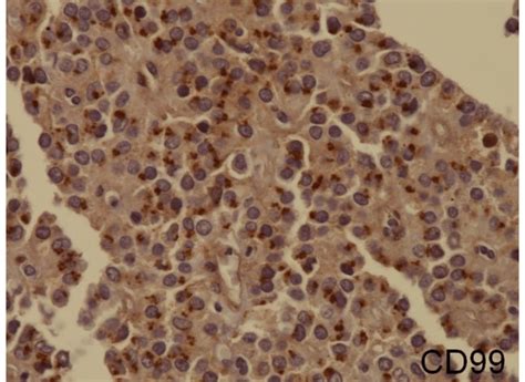 Solid Pseudopapillary Neoplasm The Neoplastic Cells Show Nuclear