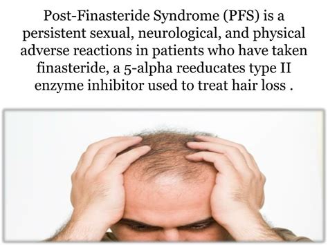 Ppt About Post Finasteride Syndrome Powerpoint Presentation Free