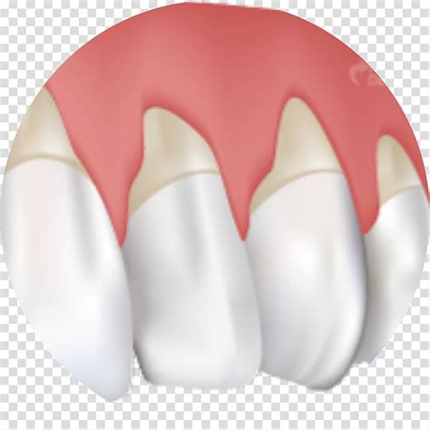 Gums Gingival Recession Gingivitis Periodontal Disease Cure Health