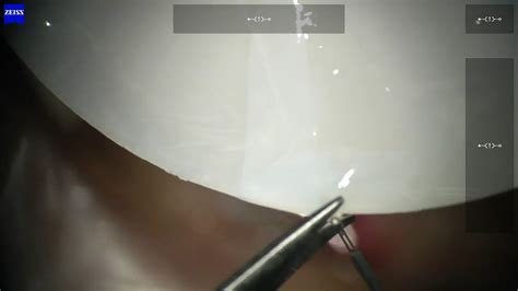 Massimo Lorusso On Linkedin Eyes Surgery Vitrectomy