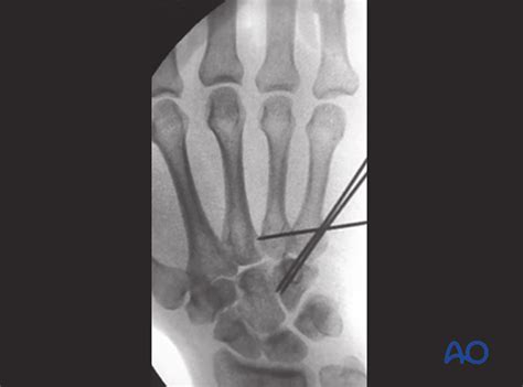 Reduction Immobilization For Dislocation And Fracture Dislocation Of The Carpometacarpal Joint