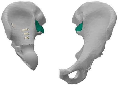 Acetabular Implant Finite Element Simulation With Customised Estimate Of Bone Properties