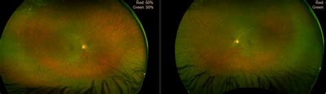 The Ods Guide To Identifying Peripheral Retinal Disease With Cheat Sheet