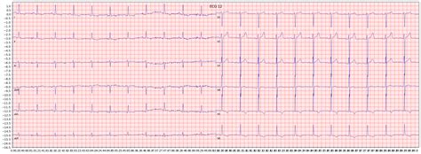 Examples Of Left Ventricular Hypertrophy Lvh Ecg Library